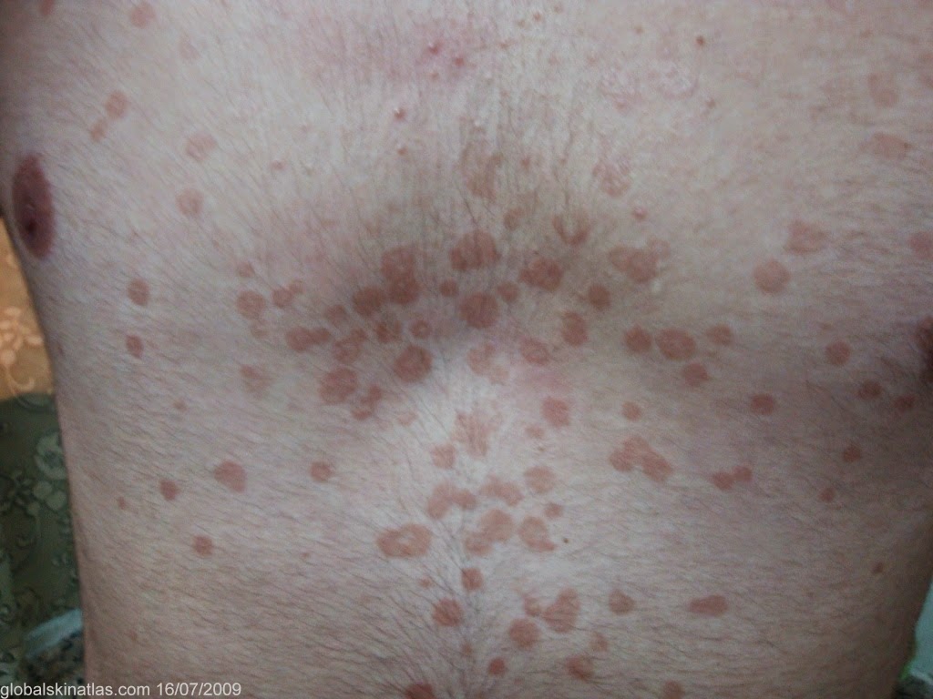 SKIN DISEASE TYPES: Tinea Versicolor