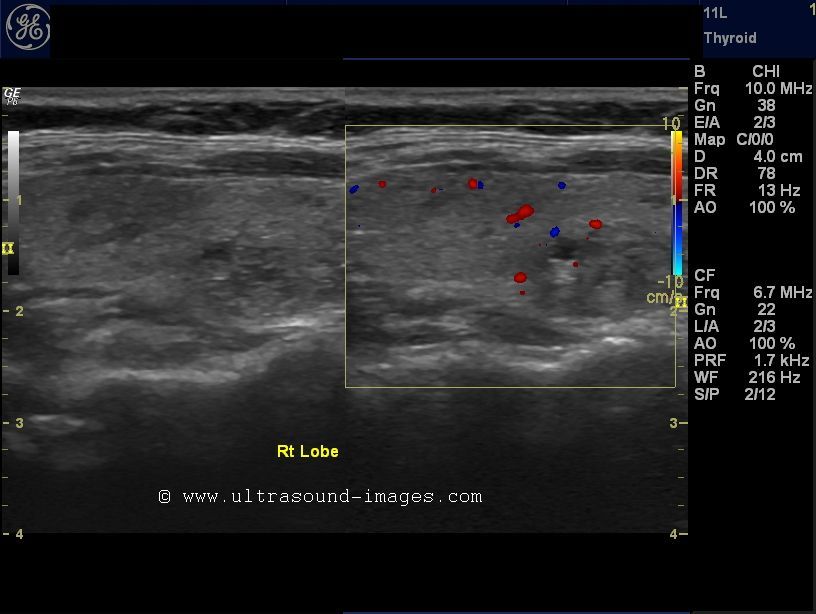 Elastography of thyroid nodules ~ Ultrasound Cases Info
