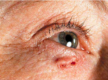 LE BLOG CURYEUX: LE CANCER ET LES YEUX