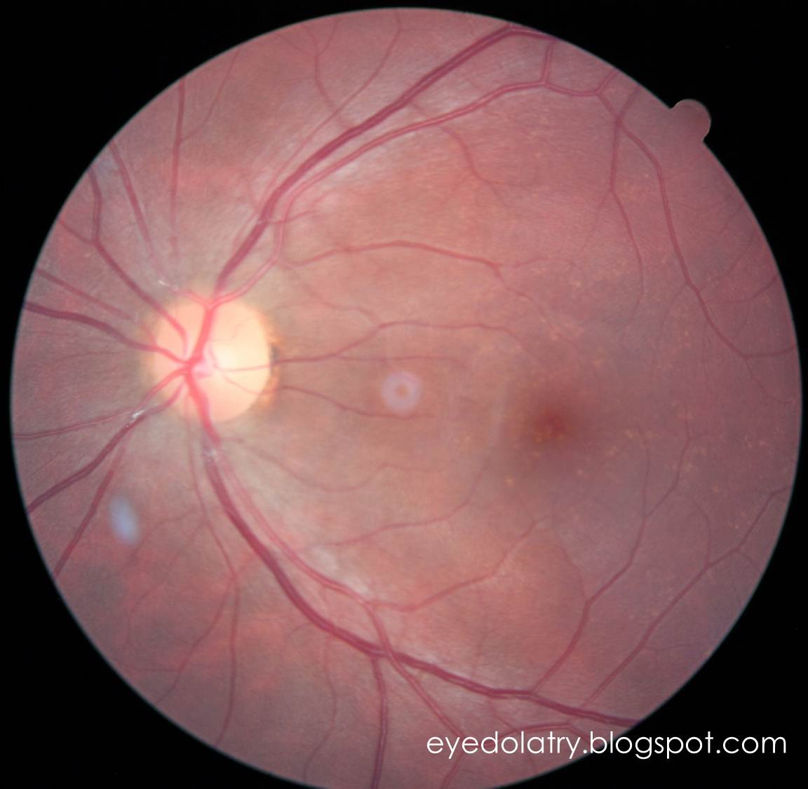 Retinal Photography - Eyedolatry