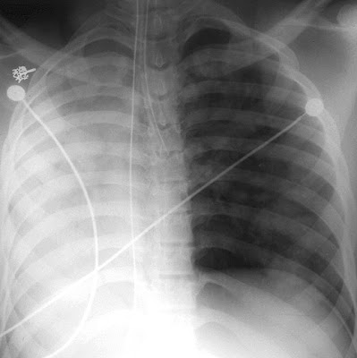 ON - RADIOLOGY: Causes of lung collapse