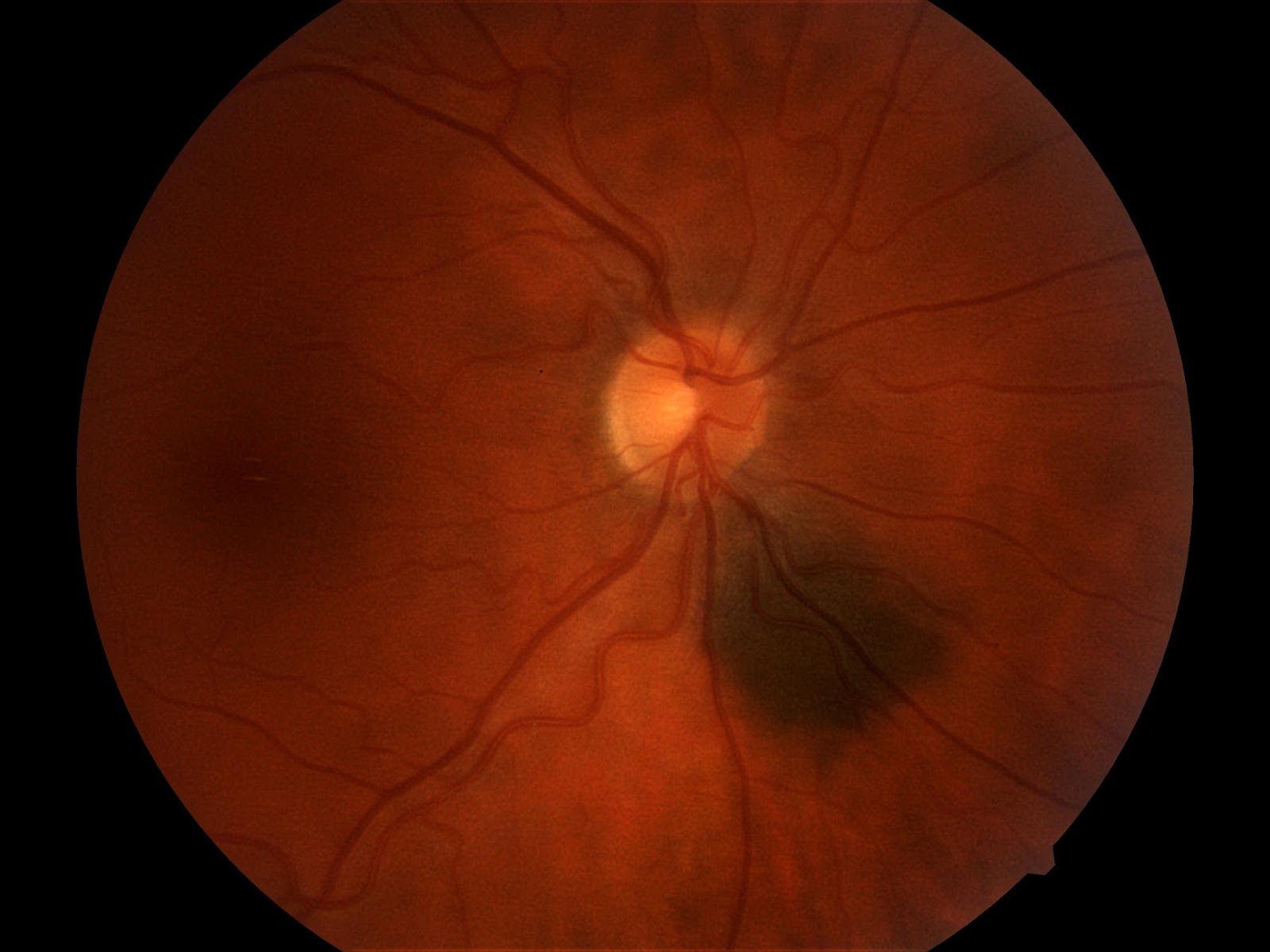 CHOROIDAL NEVUS | Sonoran Desert Eye Center