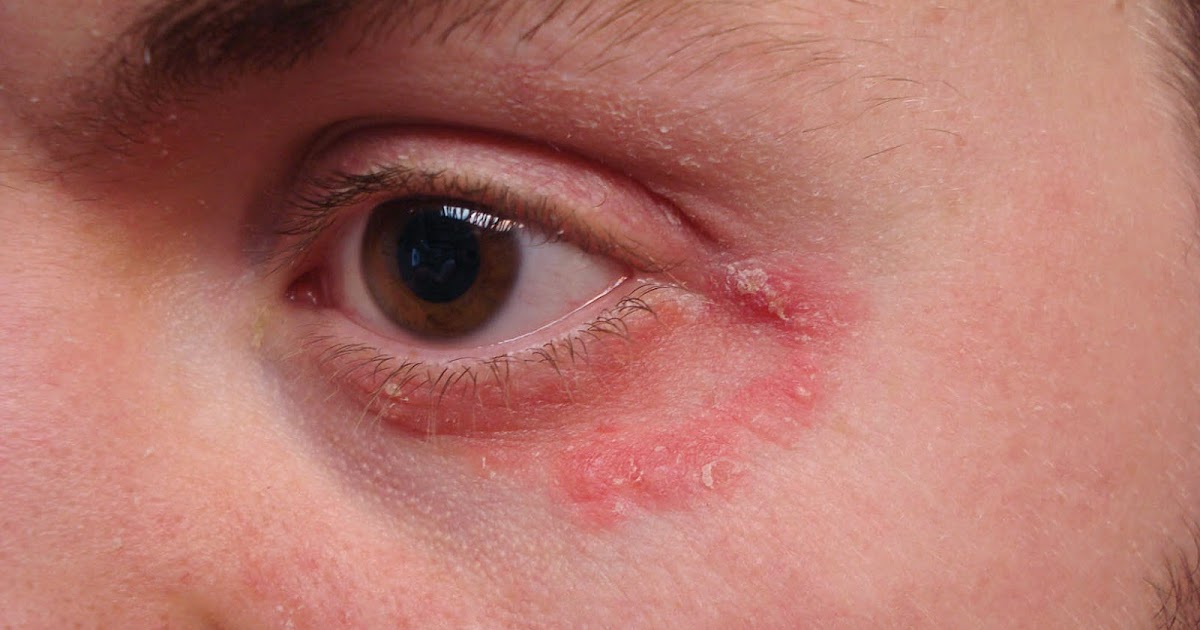VIRTUAL GRAND ROUNDS IN DERMATOLOGY 2.0: Unusual Eyelid Dermatitis