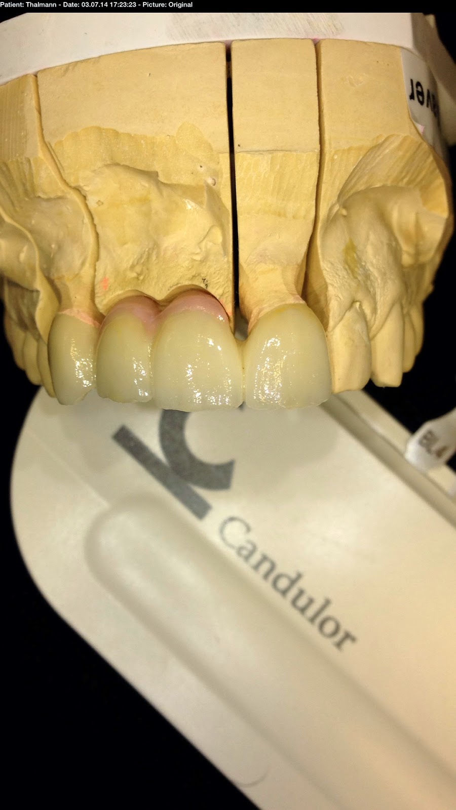 Zahnmedizin und Technik: Die Zirkon Krone oder VMK Krone
