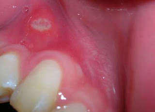 Kako Liječiti: Kako liječiti afte?