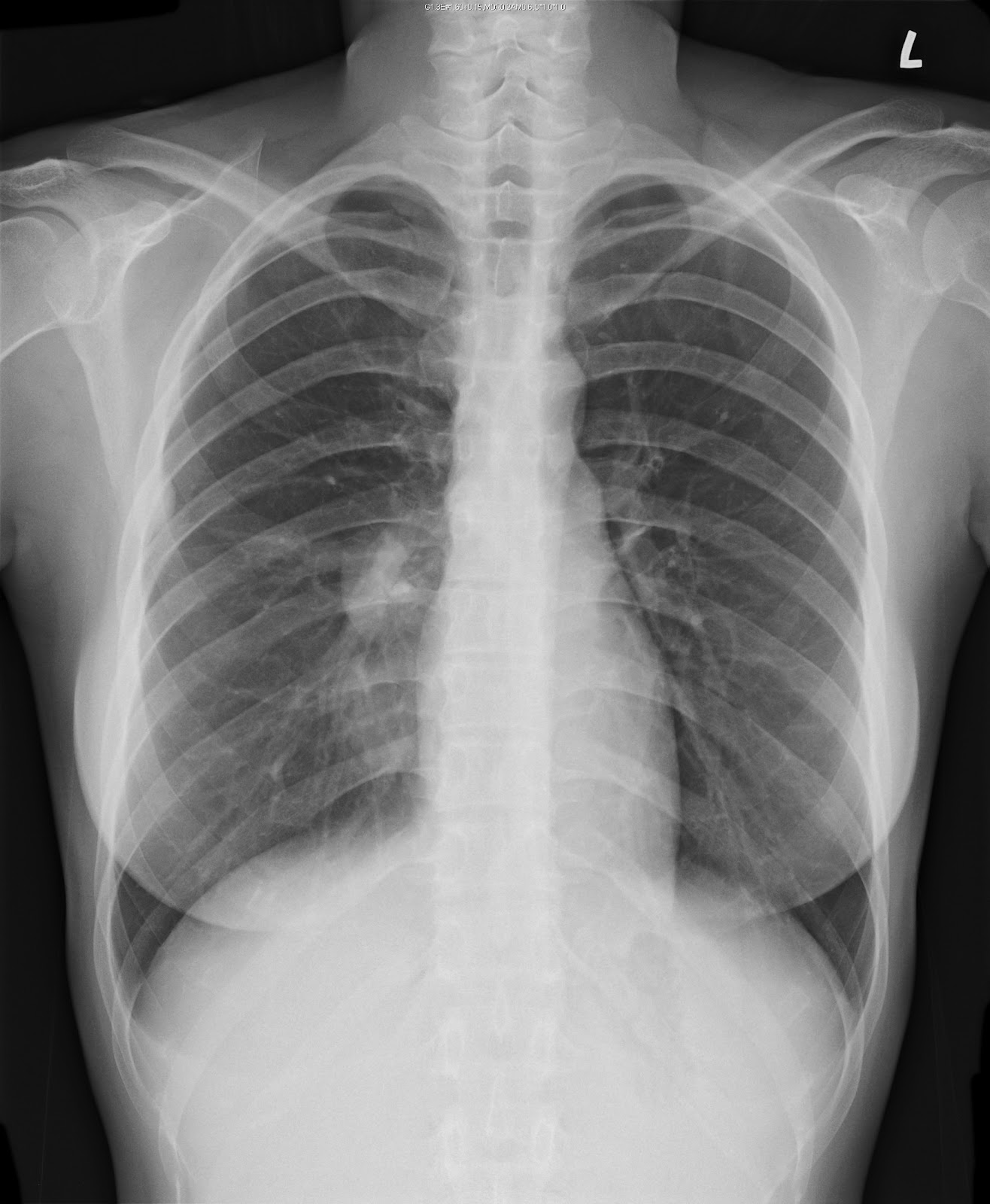 CXR 胸部x光判讀 pleural mass