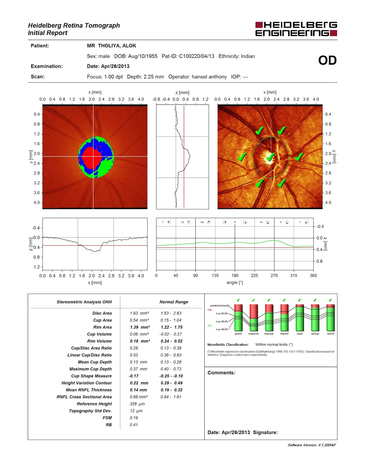 myeye: Reports of OCT and HRT tests of my right eye