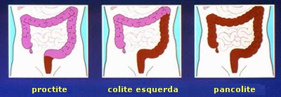 wellness coaching: Colite Ulcerosa