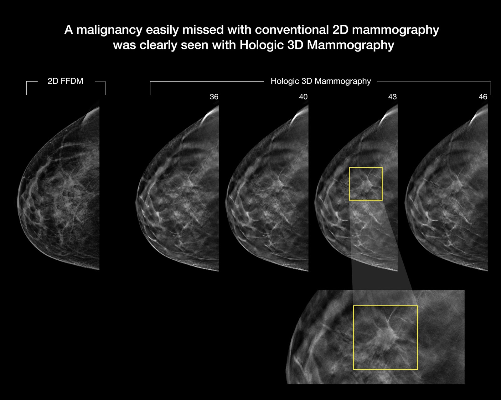 Ob/Gyn Updated : FDA labels Hologic Genius 3D Tomosynthesis Mammography superior for ...