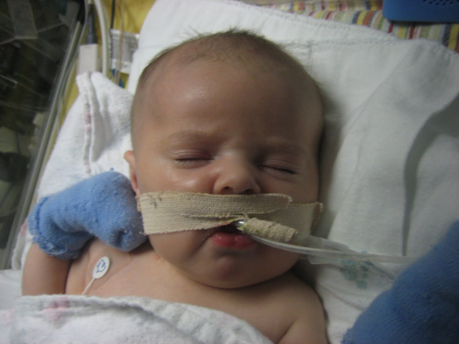 Gibson Wheelock Jones: Extubated!!