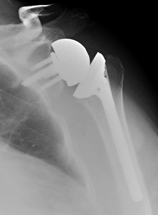 UW Shoulder and Elbow Academy: Reverse total shoulder - failure by ...
