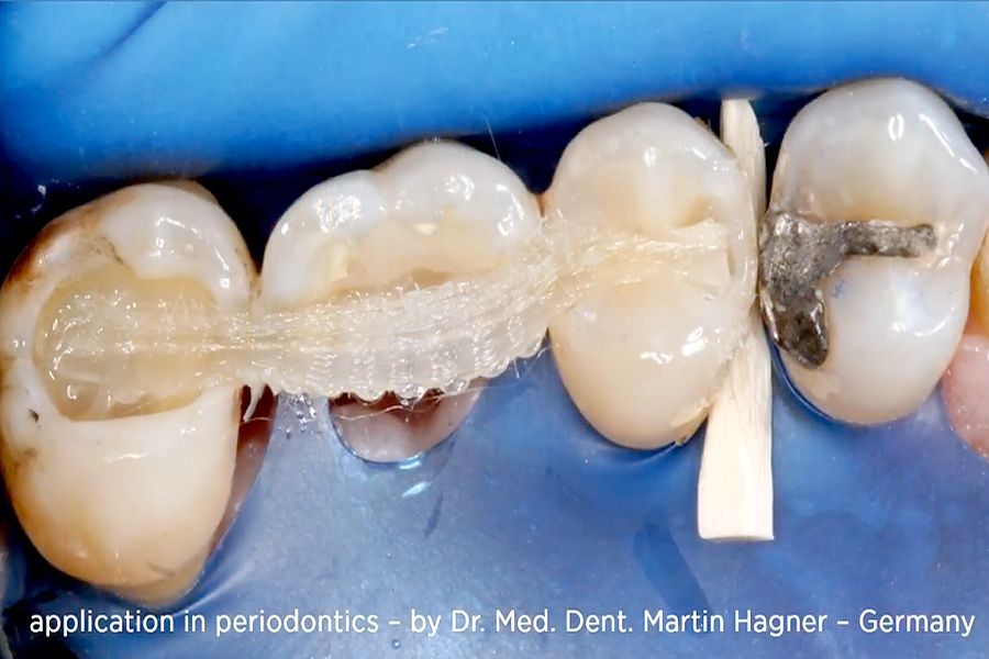 F-SPLINT-AID SLIM: Application in Periodontics for the stabilization of ...