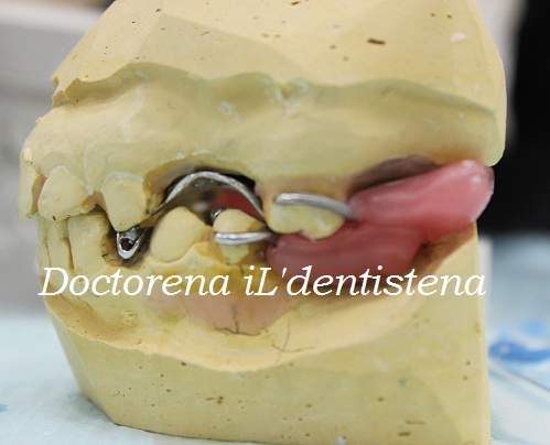 My Dental Diary: CO-Cr. RPD