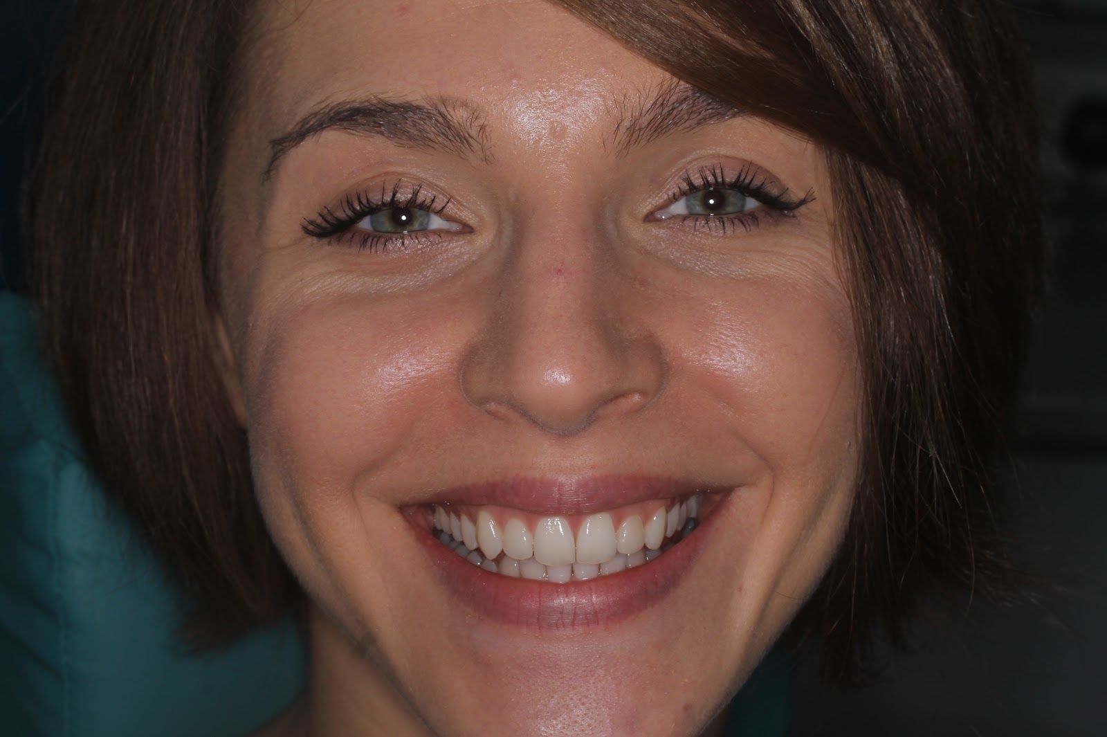 Richard Charon BDS: "Snaggle Teeth" to Lovely Smile with Invisalign®