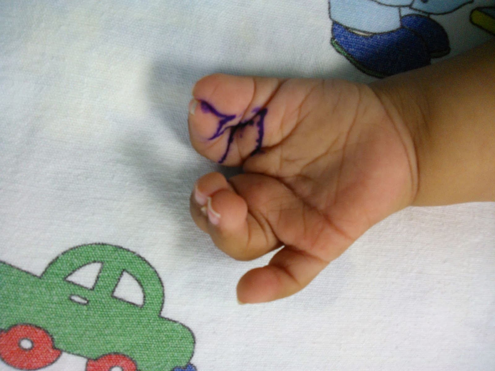 Cirugía de Mano y Traumatología: Sindactilia completa simple de primer ...