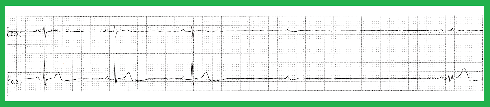 Various Sinus Arrests and Sinus Pauses