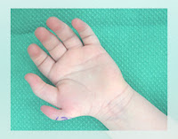 Nuestro esqueleto: Miembro superior: Malformaciones óseas de la mano