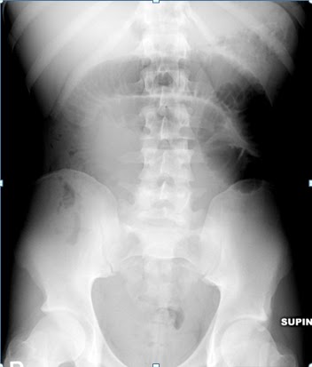 Oktahermoniza Blog's: Obstruksi intestinal