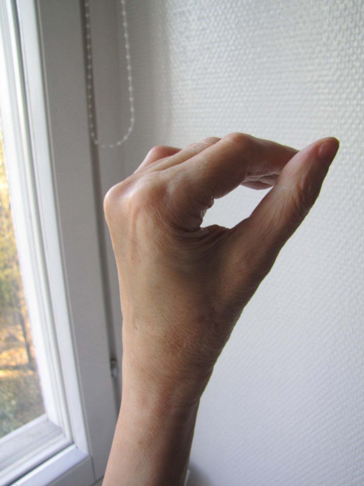 Hand rehabilitation experience with Dupuytren's contracture ...