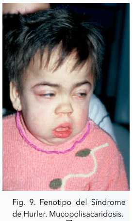 RED LATINOAMERICANA DE PEDIATRÍA Y NEONATOLOGÍA: Malformaciones ...