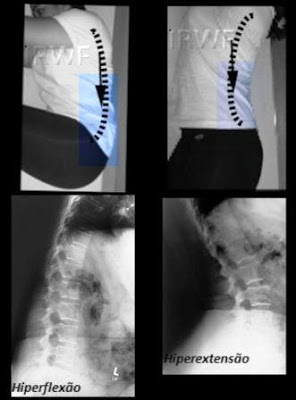 Lombar- Hiperextensão e Hiperflexão H.H.
