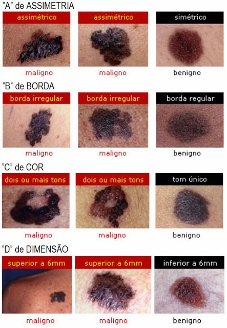Salus Agência: Quando uma pinta pode ser perigosa?