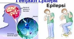 Mengenal Epilepsi - Ummi Dokter