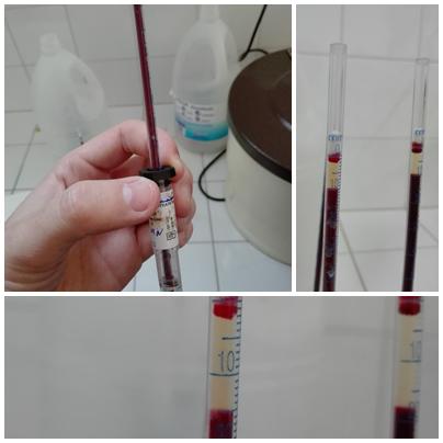 Laboratorio Clínico y Biomédico: 11 HEMATOLOGÍA: Determinación de VSG.