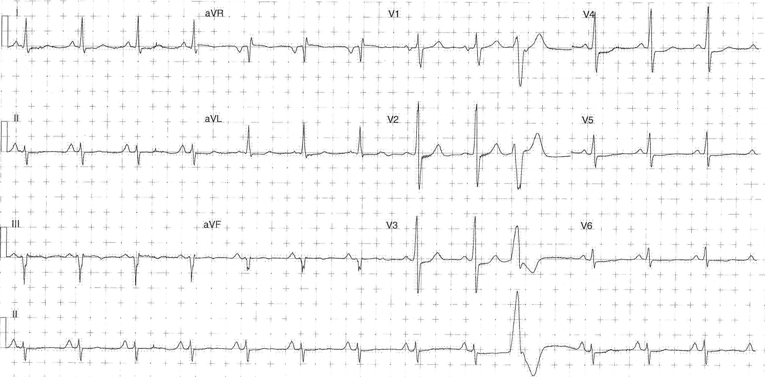 ECG of the Week: ECG of the Week - 10th April - Interpretation