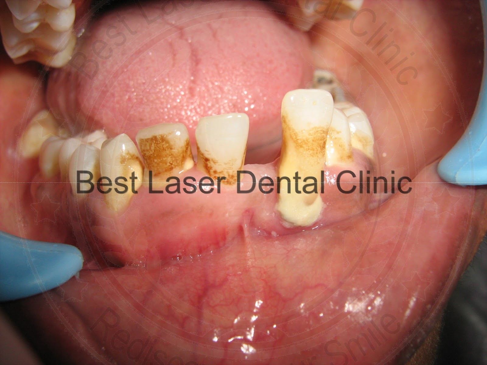 Gallery 6-Immediate Dental Implant placement in a periodontaly weakened ...