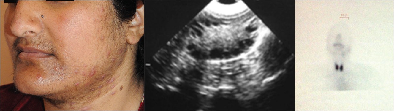 DermaSphere: PCOS — My Skin & Me