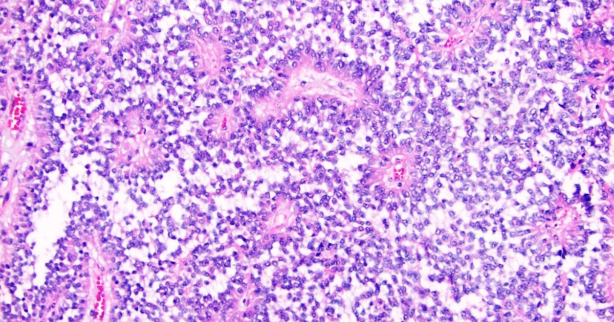 neuropathology blog: Malignant astroblastoma in a 23-year-old female