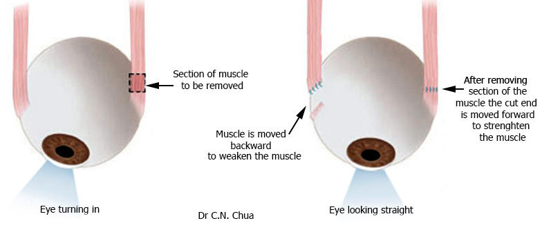 Eyelid Surgery by Prof Dr CN CHUA 蔡鐘能: 2016