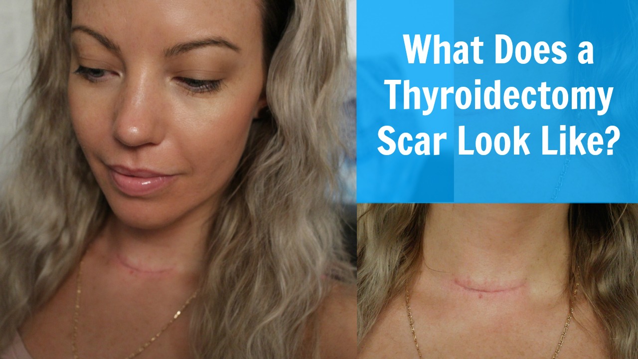 What Does A Thyroidectomy Scar Look Like? | EmmaTara