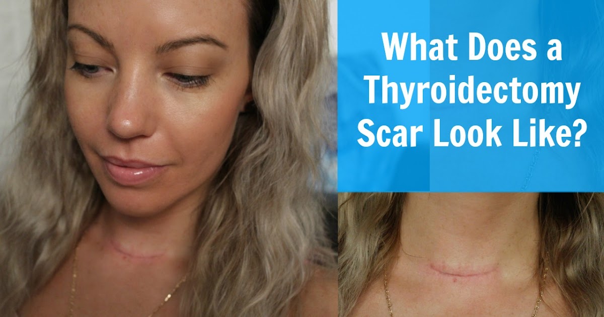 What Does A Thyroidectomy Scar Look Like? | EmmaTara
