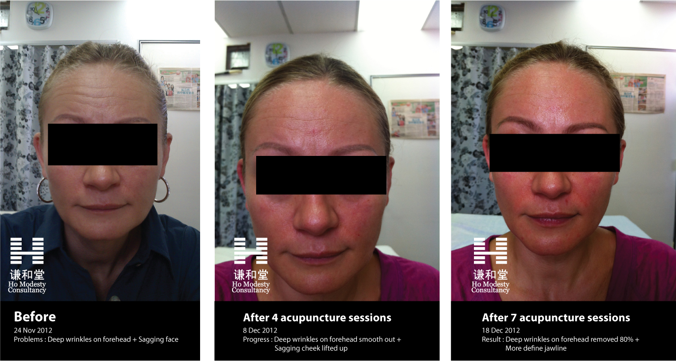 Ho Modesty Consultancy Acupuncture And Chinese Herbs Rough Forehead