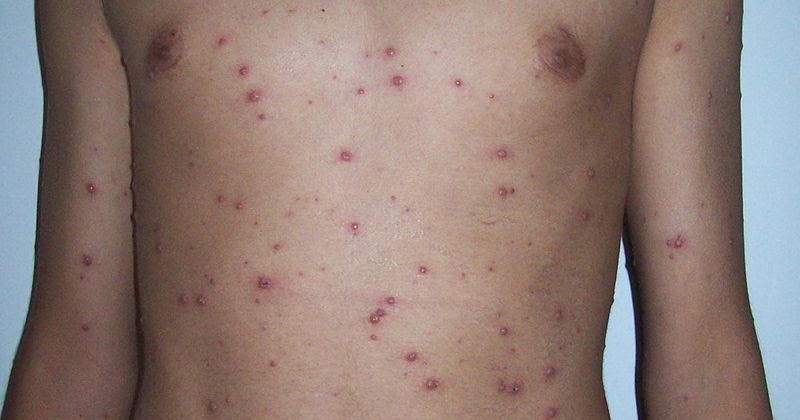 Chicken pox