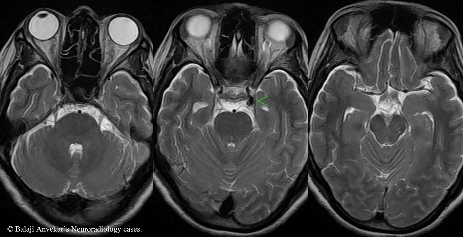 Dr Balaji Anvekar FRCR: Aneurysmal 3rd CN palsy
