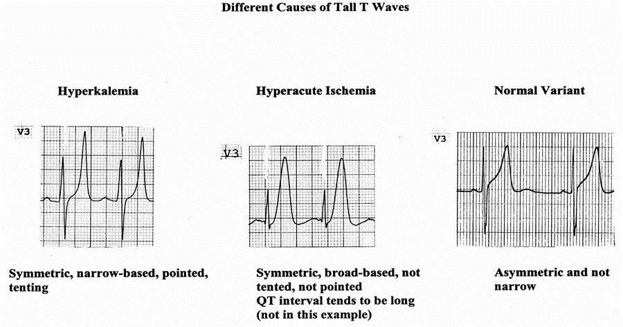 Medical Addicts: Tall T wave on ECG
