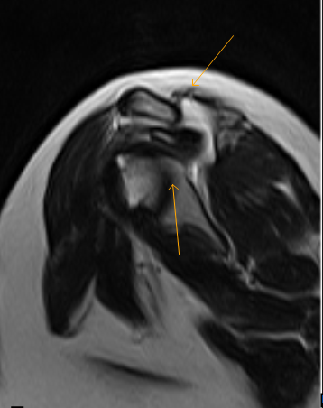 Os Acromiale with Impingement-MRI - Sumer's Radiology Blog