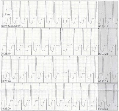 Pedi cardiology: ICU, EP: DDD pacemaker