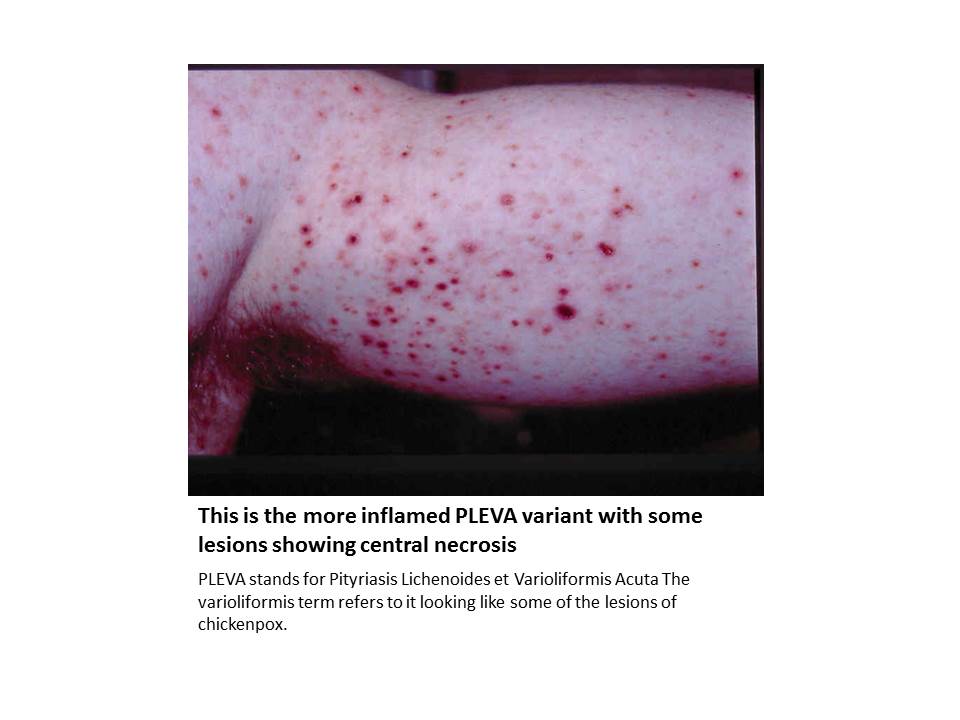 Consultations in Dermatology: Pityriasis Lichenoides PLEVA