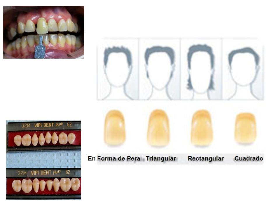 REHABILITACIÓN II: Selección y colocación de dientes artificiales y ...