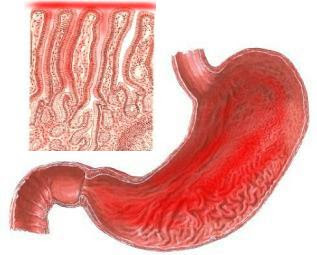 Clinical Manifestations of Acute Gastritis and Chronic Gastritis