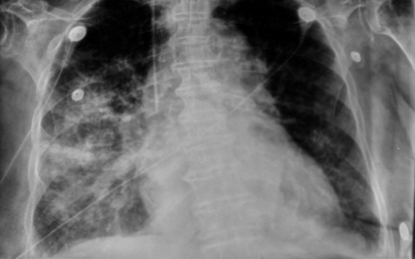 Neumonia Por Aspiracion