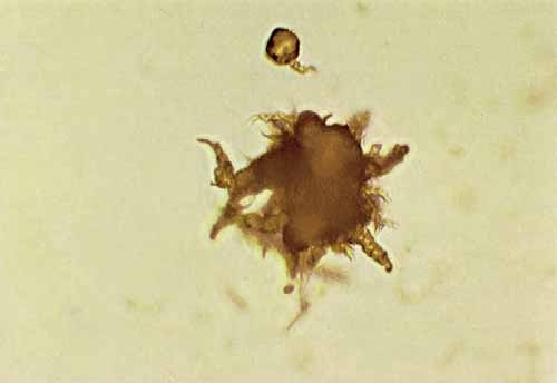 Atlas of Crystals found in alkaline urine | Free Medical Atlas