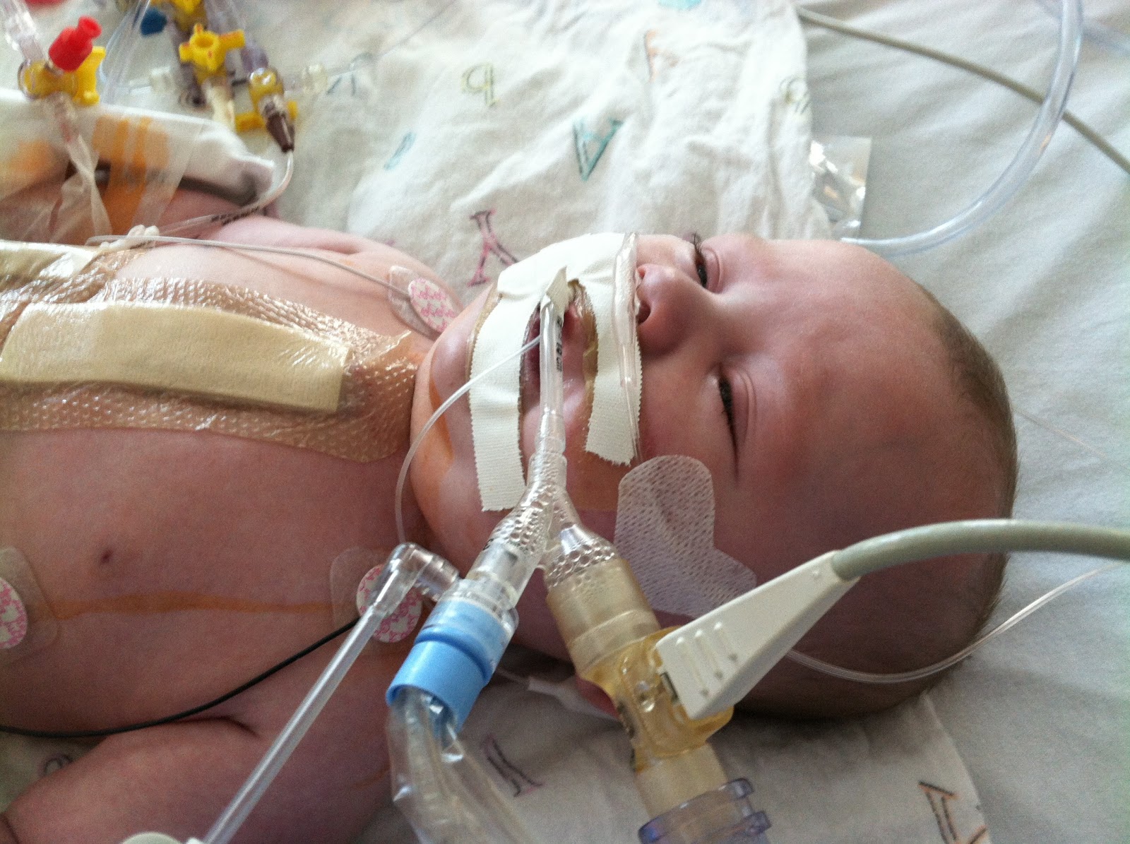 Swope World: Glenn Procedure