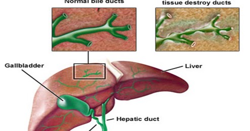 Herbal Remedies for PSC Liver Disease - Primary Sclerosing Cholangitis ...