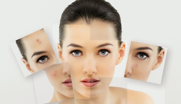 Perawatan Kulit Wajah Berminyak dan Berjerawat - Cara Merawat Kulit Wajah