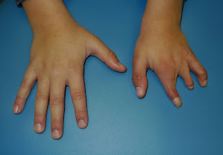 Symbrachydactyly | Congenital Hand and Arm Differences | Washington ...
